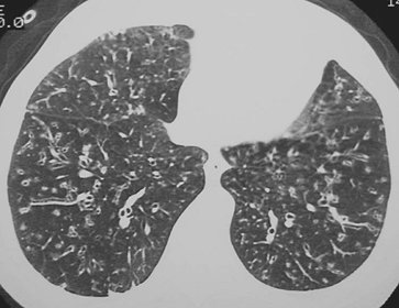 Ovid: Chest Radiology: The Essentials