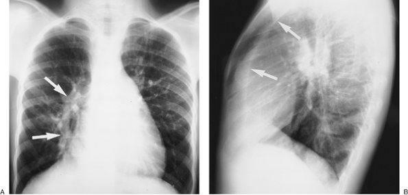 Ovid: Chest Radiology: The Essentials