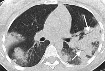 Ovid: Chest Radiology: The Essentials