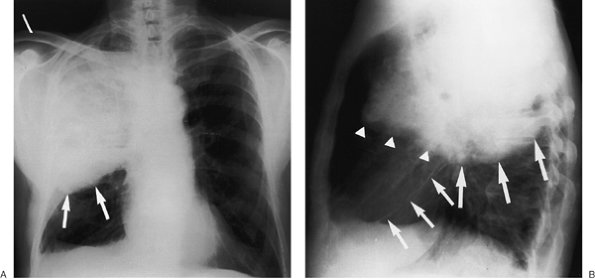 Ovid: Chest Radiology: The Essentials