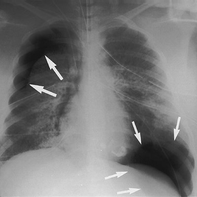 Ovid: Chest Radiology: The Essentials