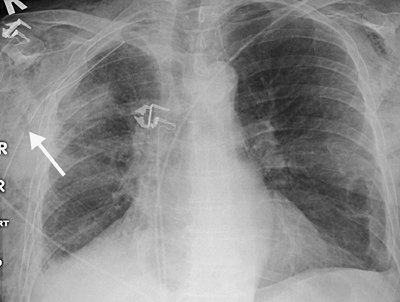 Ovid: Chest Radiology: The Essentials
