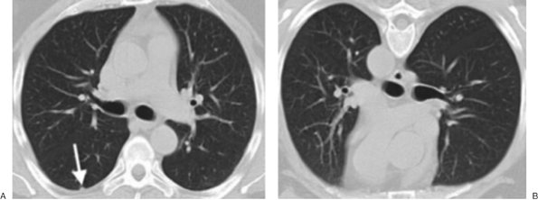 Ovid: Chest Radiology: The Essentials